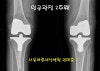 퇴행성무릎관절염치료방법 인공관절수술 By 정형외과 전문의 권제호 무릎 수술 일지 네이버 블로그